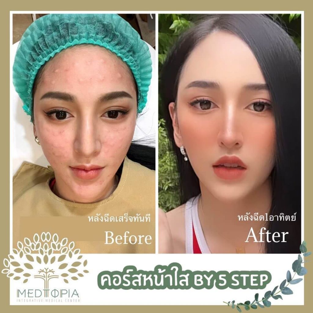 รีวิว 7 วันหลังมาทำคอร์ส หน้าใส เปิดผิวกระจก หน้าฉ่ำ - Medtopia
